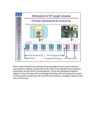 3D brachytherapy - definition and delineation of the target volumes ...
