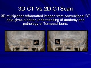 3D CT Middle and Inner Ear | PPT