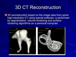 3D CT Middle and Inner Ear | PPT