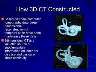 3D CT Middle and Inner Ear | PPT