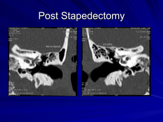 3D CT Middle and Inner Ear | PPT