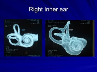3D CT Middle and Inner Ear | PPT