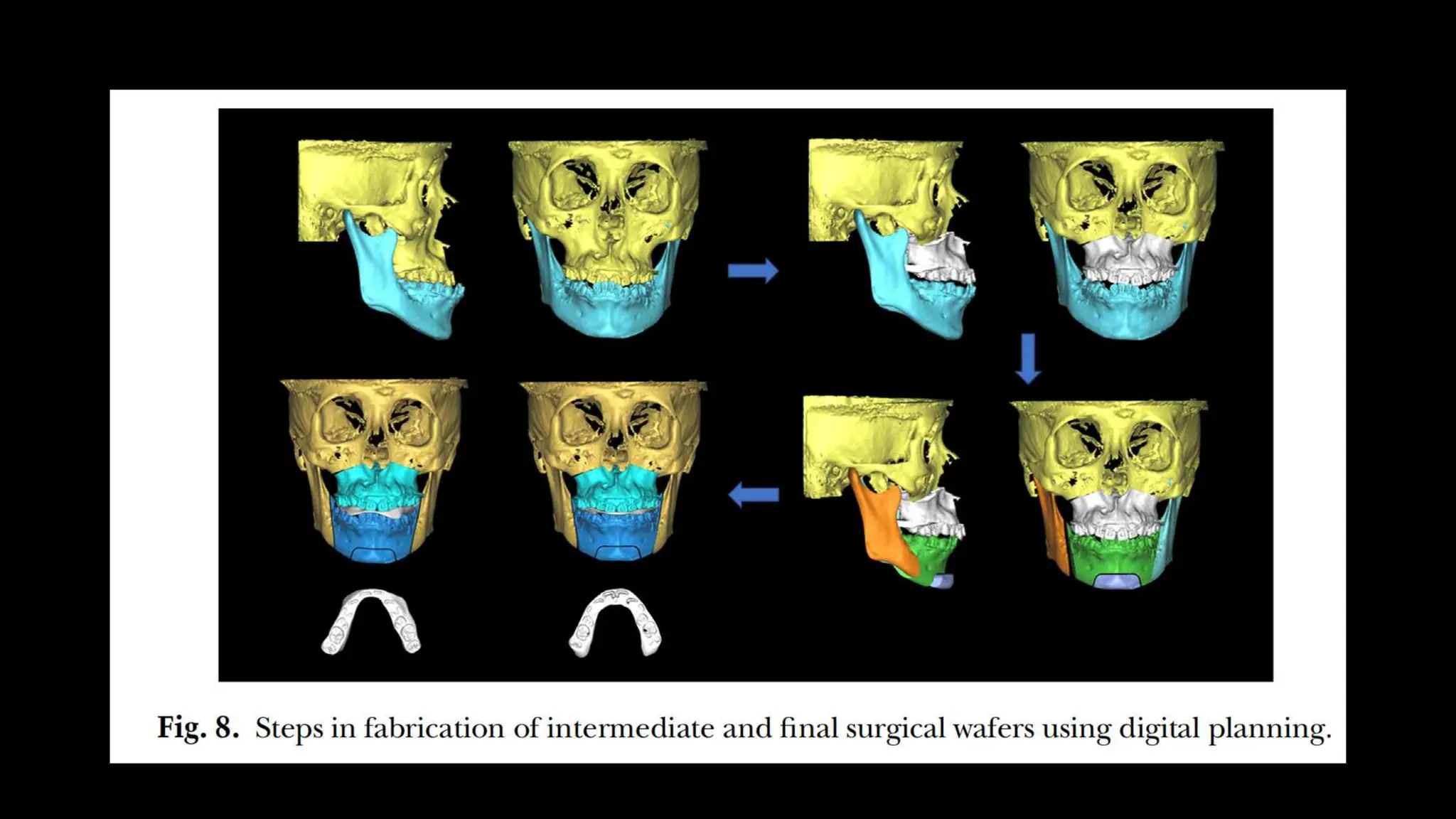 3D driven protocol for surgery first orthognathic approach.pptx