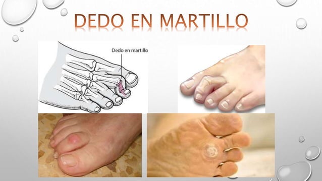 DIAGNOSTICO, TRATAMIENTO DEDO EN MARTILLO | PPTX | Physical Therapy ...