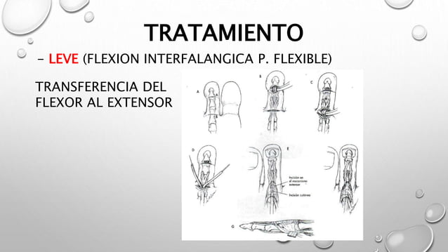 DIAGNOSTICO, TRATAMIENTO DEDO EN MARTILLO | PPTX | Physical Therapy ...