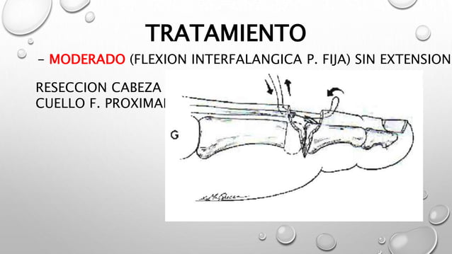 DIAGNOSTICO, TRATAMIENTO DEDO EN MARTILLO | PPTX | Physical Therapy ...