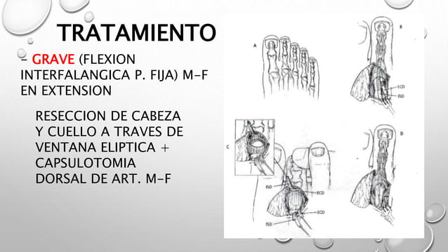 DIAGNOSTICO, TRATAMIENTO DEDO EN MARTILLO | PPTX | Physical Therapy ...