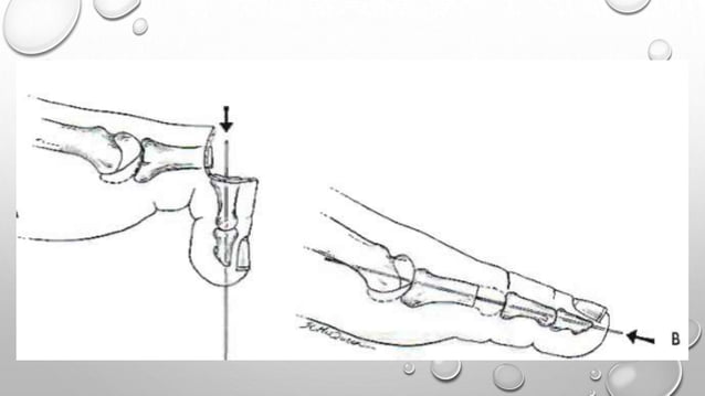 DIAGNOSTICO, TRATAMIENTO DEDO EN MARTILLO | PPTX | Physical Therapy ...