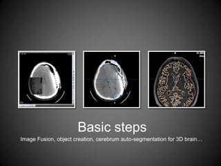 3 D Grid Modeling With Brain Lab | PPTX