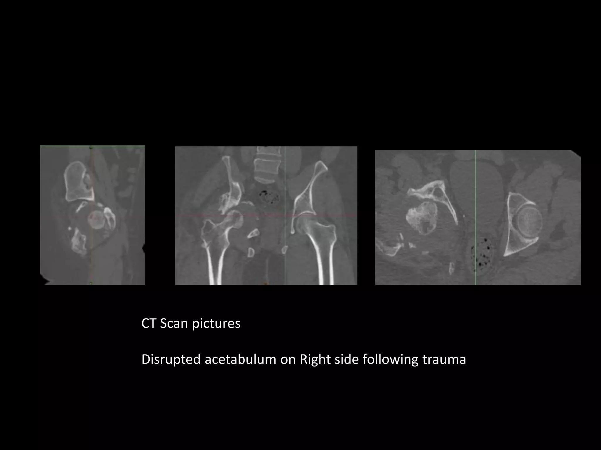 Role of 3D printing & 3D model in Complex Total Hip Replacement | PPT