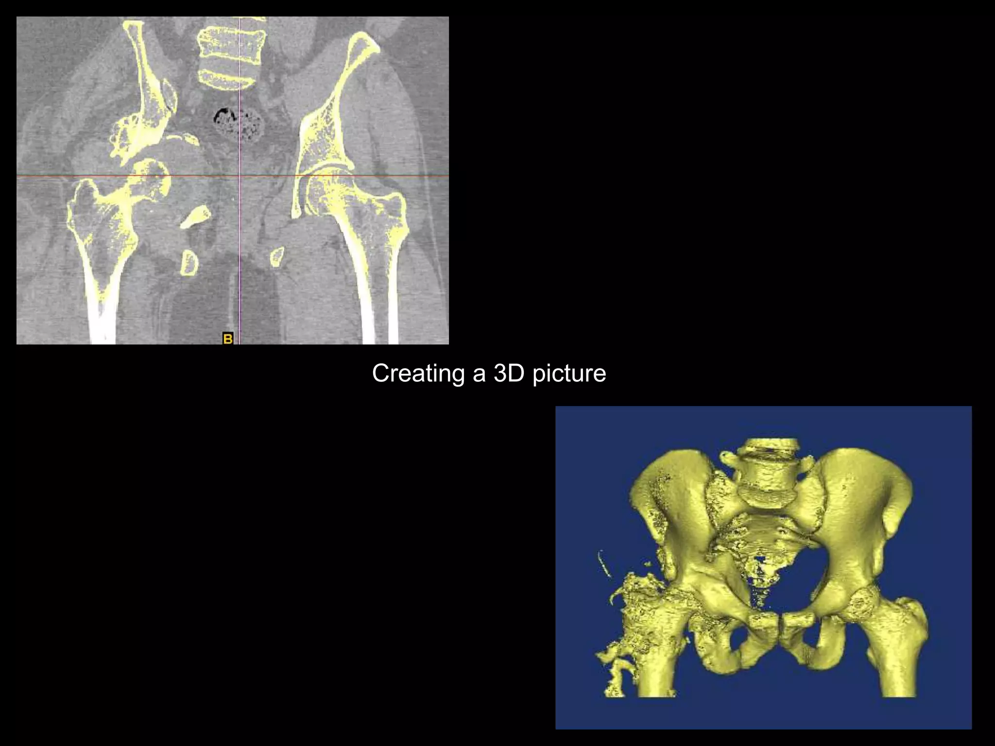 Role of 3D printing & 3D model in Complex Total Hip Replacement | PPTX