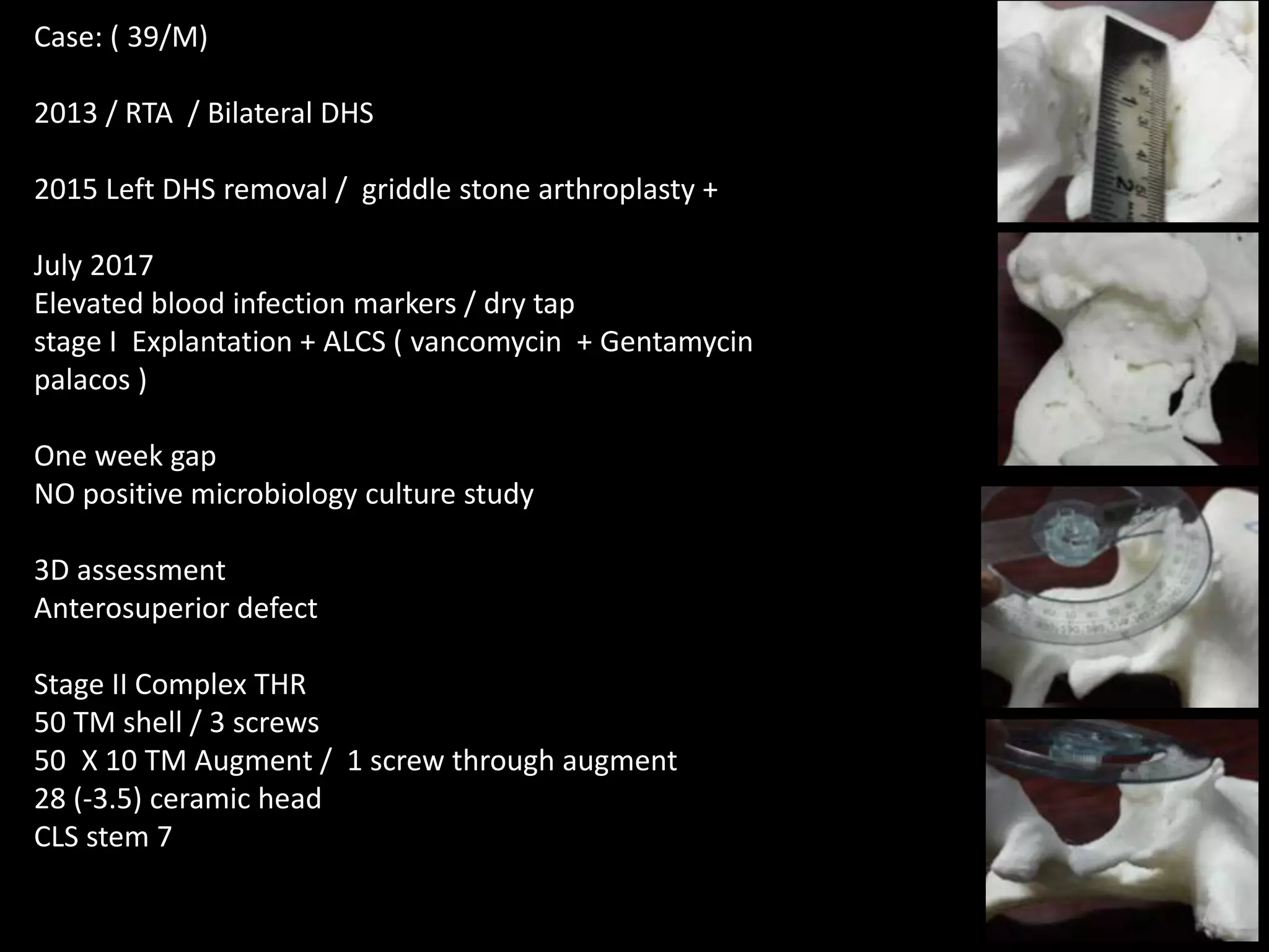 Role of 3D printing & 3D model in Complex Total Hip Replacement | PPTX