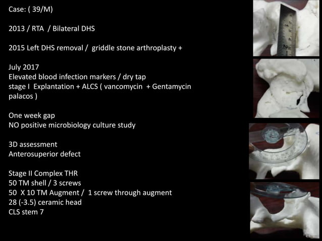 Role of 3D printing & 3D model in Complex Total Hip Replacement | PPT
