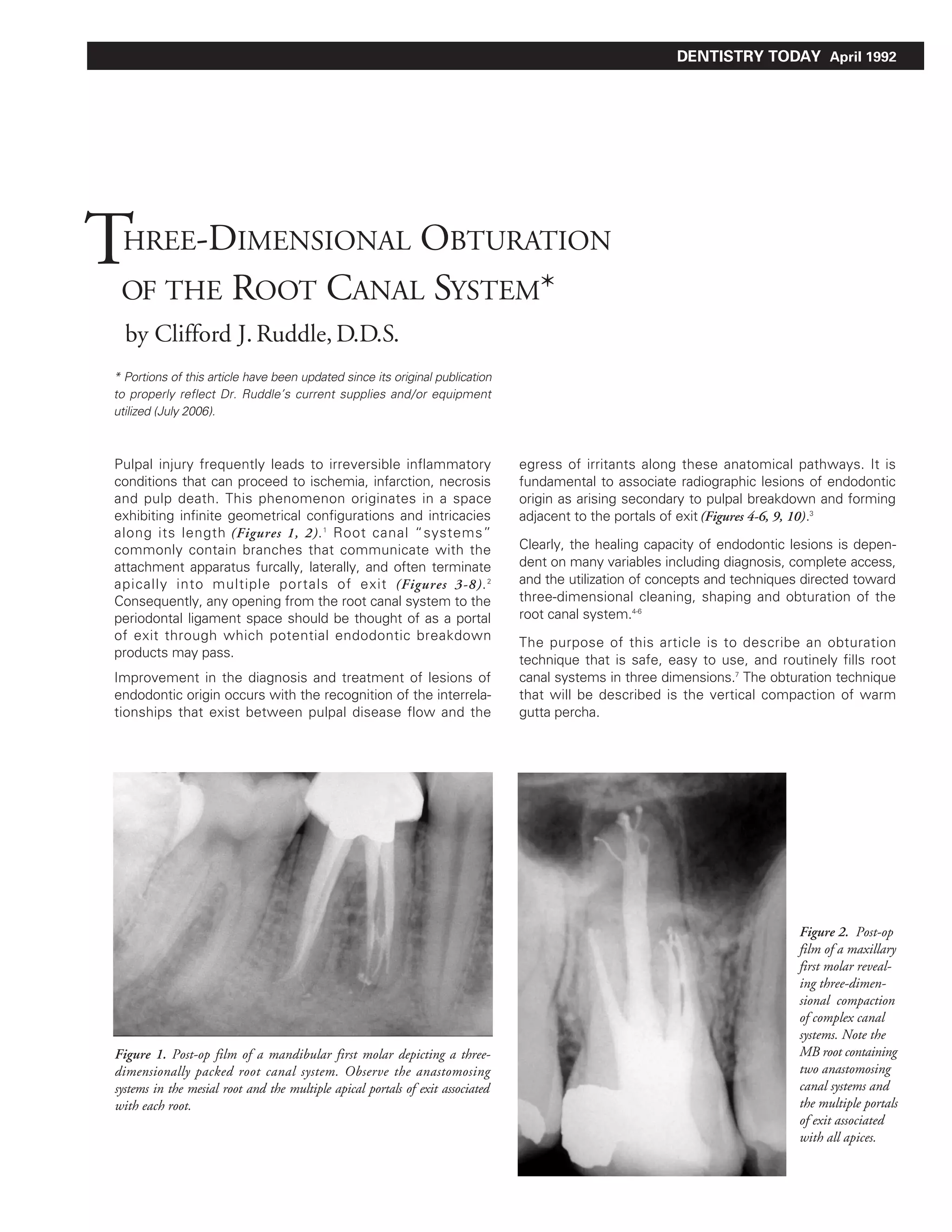 THREE-DIMENSIONAL OBTURATION OF THE ROOT CANAL SYSTEM* by Clifford J ...