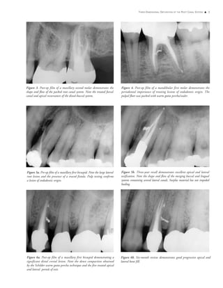 THREE-DIMENSIONAL OBTURATION OF THE ROOT CANAL SYSTEM* by Clifford J ...