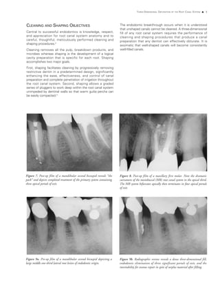 THREE-DIMENSIONAL OBTURATION OF THE ROOT CANAL SYSTEM* by Clifford J ...