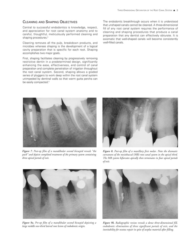 THREE-DIMENSIONAL OBTURATION OF THE ROOT CANAL SYSTEM* by Clifford J ...