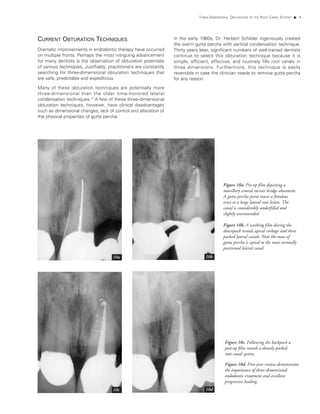 THREE-DIMENSIONAL OBTURATION OF THE ROOT CANAL SYSTEM* by Clifford J ...