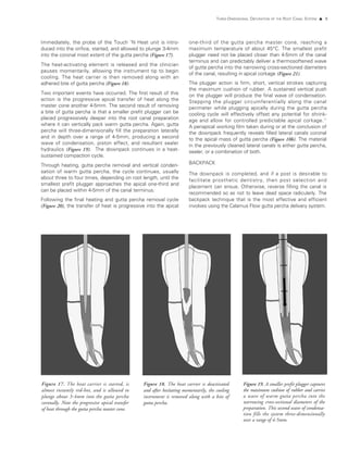 THREE-DIMENSIONAL OBTURATION OF THE ROOT CANAL SYSTEM* by Clifford J ...