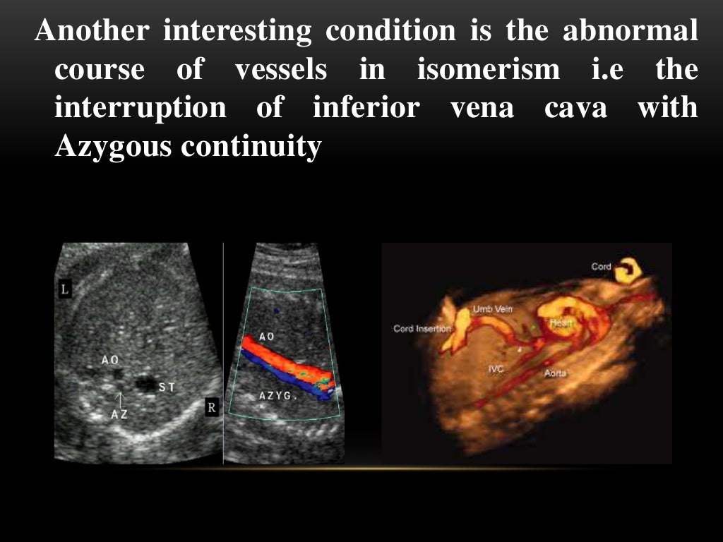 3 D Power Doppler Ultrasound