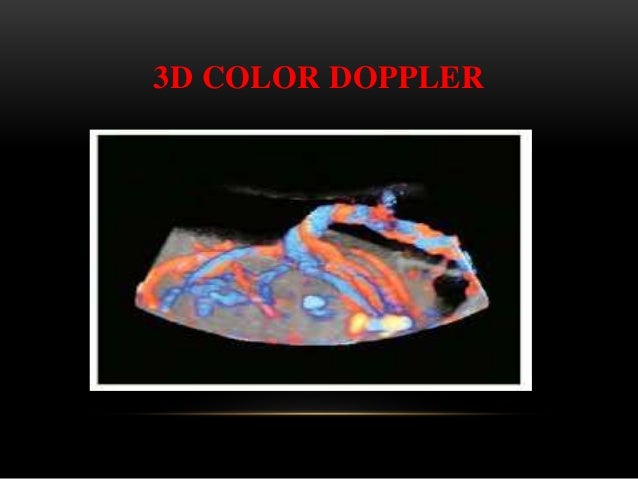 3 D Power Doppler Ultrasound