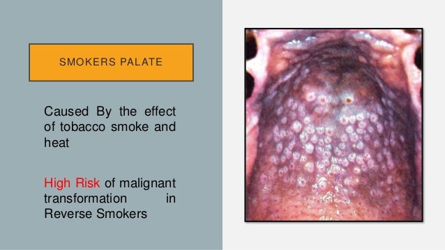 oral cancer npcdcs_dept community med