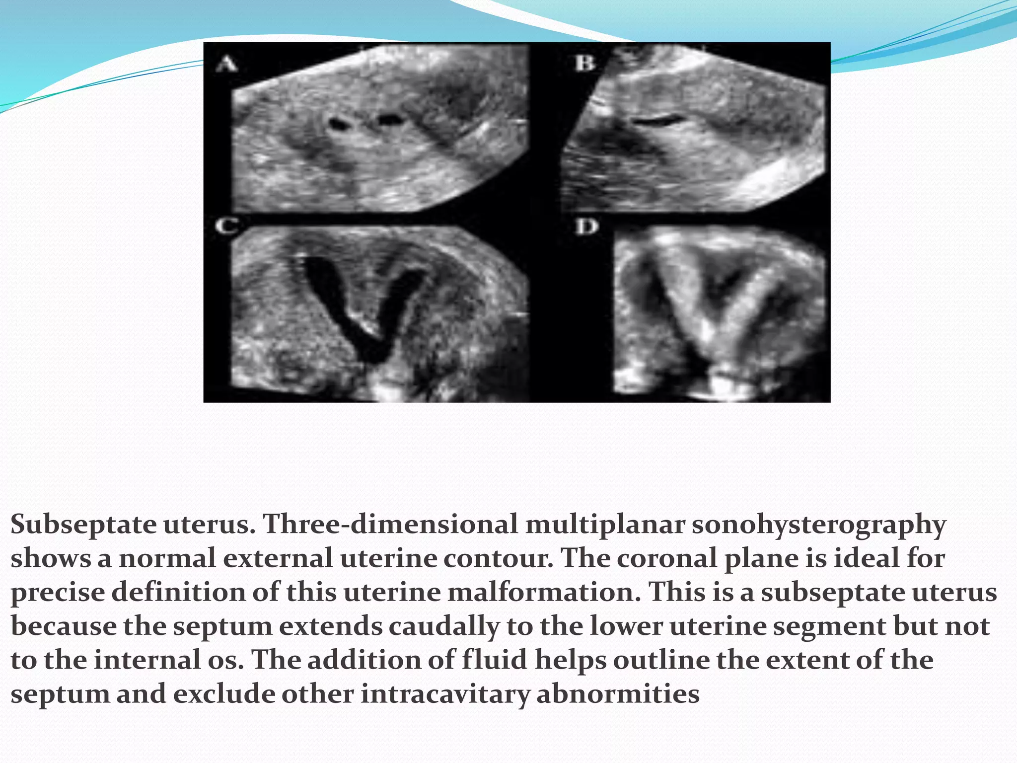 3 d ultrasound in gynecology presentation | PPTX