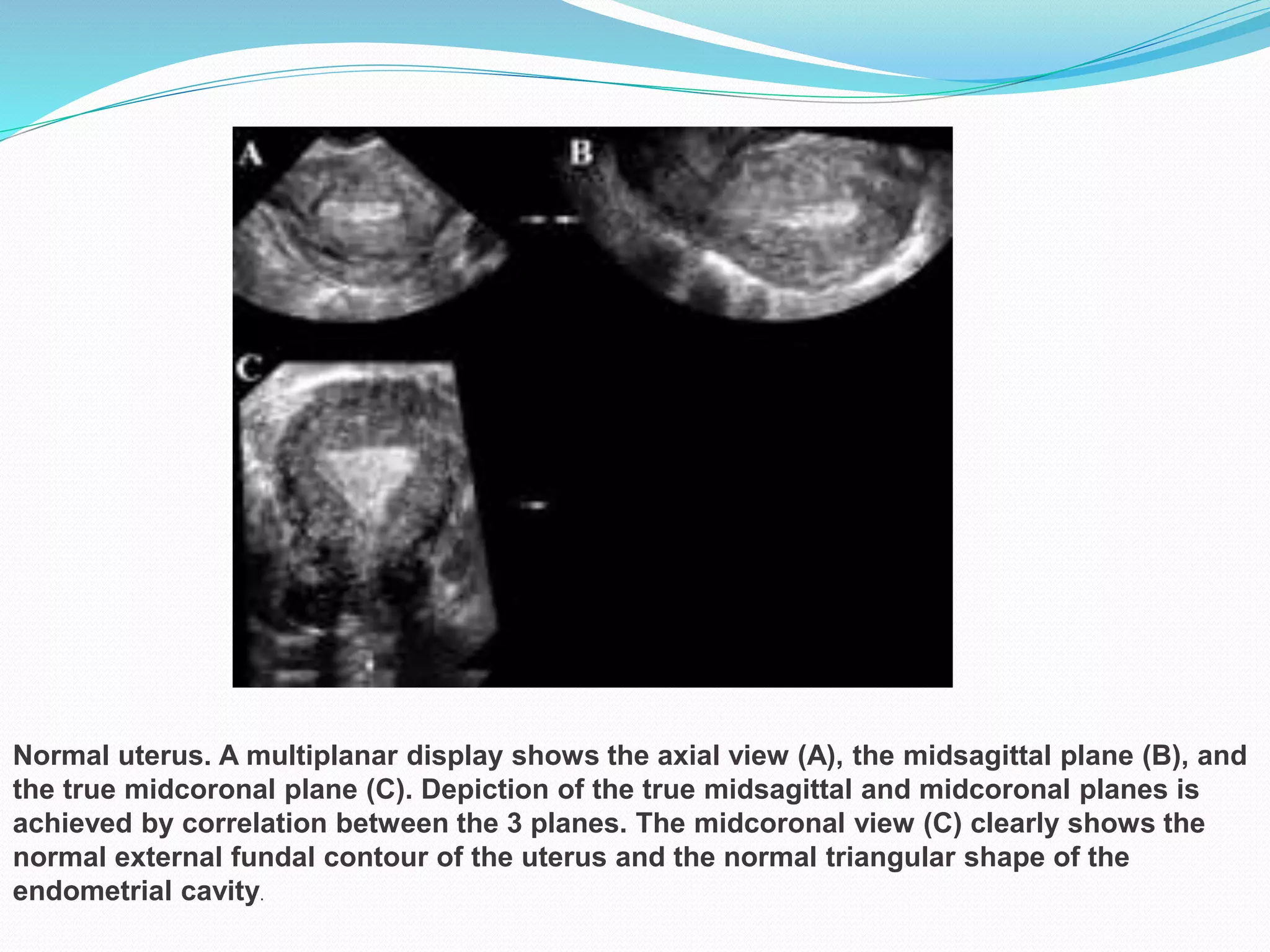 3 d ultrasound in gynecology presentation | PPTX