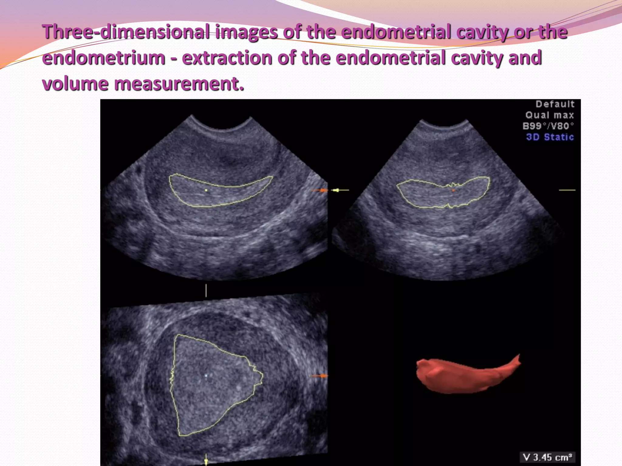 3 D Ultrasound in reproductive medicine | PDF