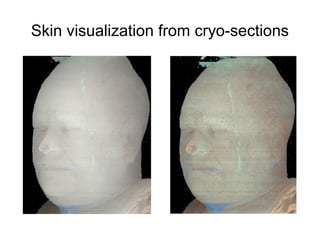 3D visualisation of medical images | PPT