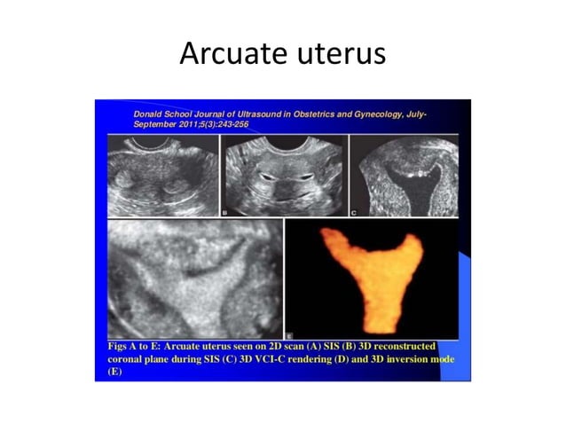3d vs hsg for tubal evaluation | PPTX | Pregnancy | Reproductive Health