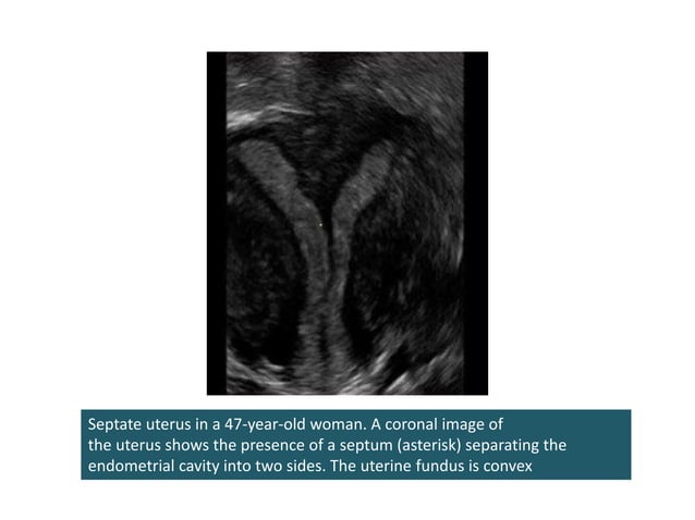 3d vs hsg for tubal evaluation | PPTX | Pregnancy | Reproductive Health