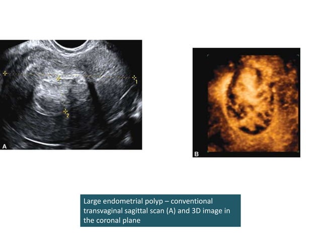 3d vs hsg for tubal evaluation | PPTX | Pregnancy | Reproductive Health
