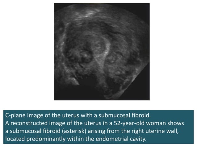 3d vs hsg for tubal evaluation | PPTX | Pregnancy | Reproductive Health