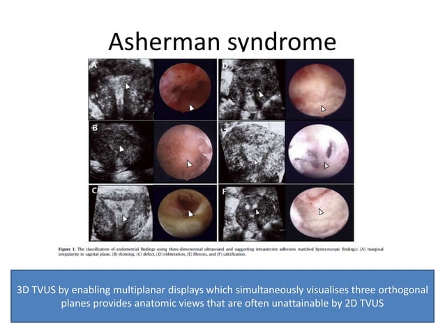 3d vs hsg for tubal evaluation | PPTX | Pregnancy | Reproductive Health