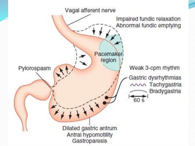 Functional dyspepsia-Approach