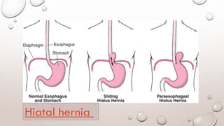 Gastro-esophageal Reflux Disease | PDF