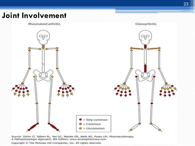 Rheumatoid Arthritis