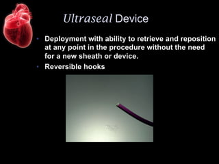 Ultraseal LAA | PDF
