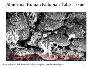 PELVIC INFLAMMATORY DISEASE | PPTX