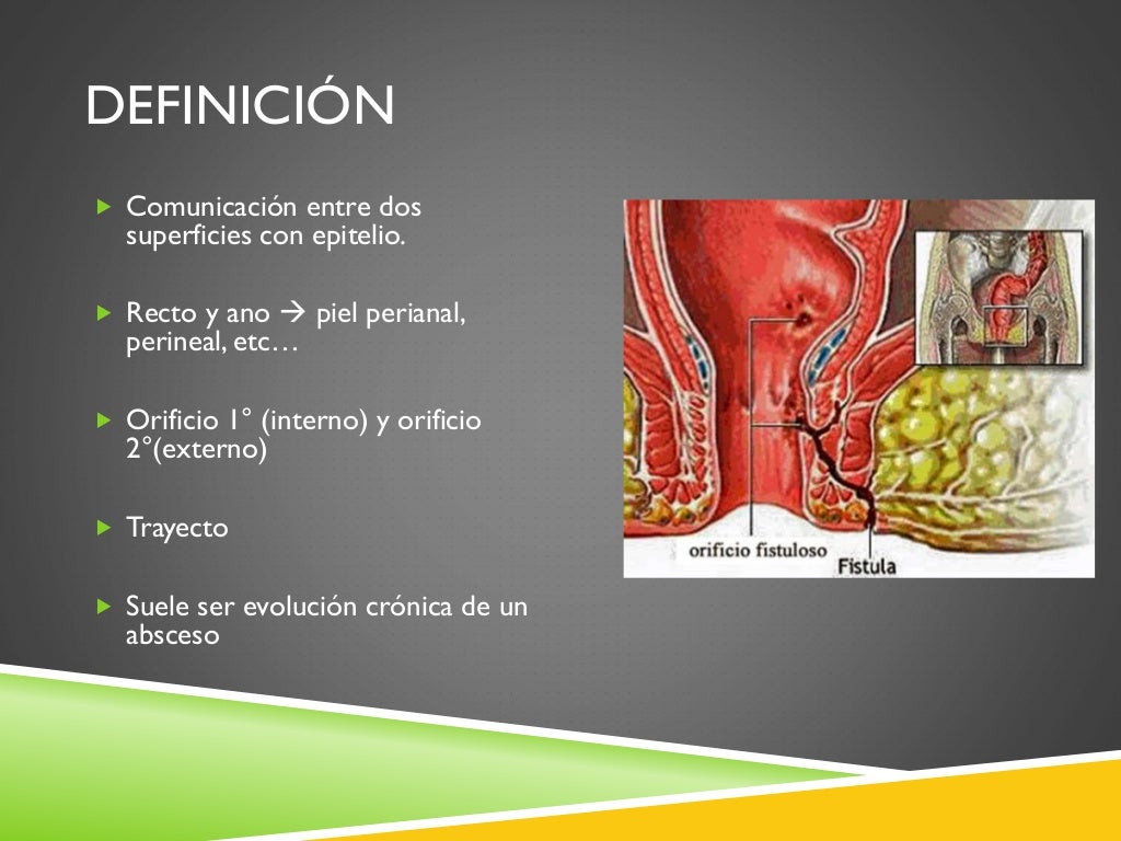 fistulas