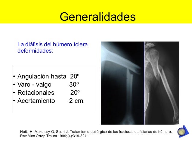 3 fr diafisis humero Dr. Miguel Mite
