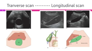 sonography of gallbladder | PPTX