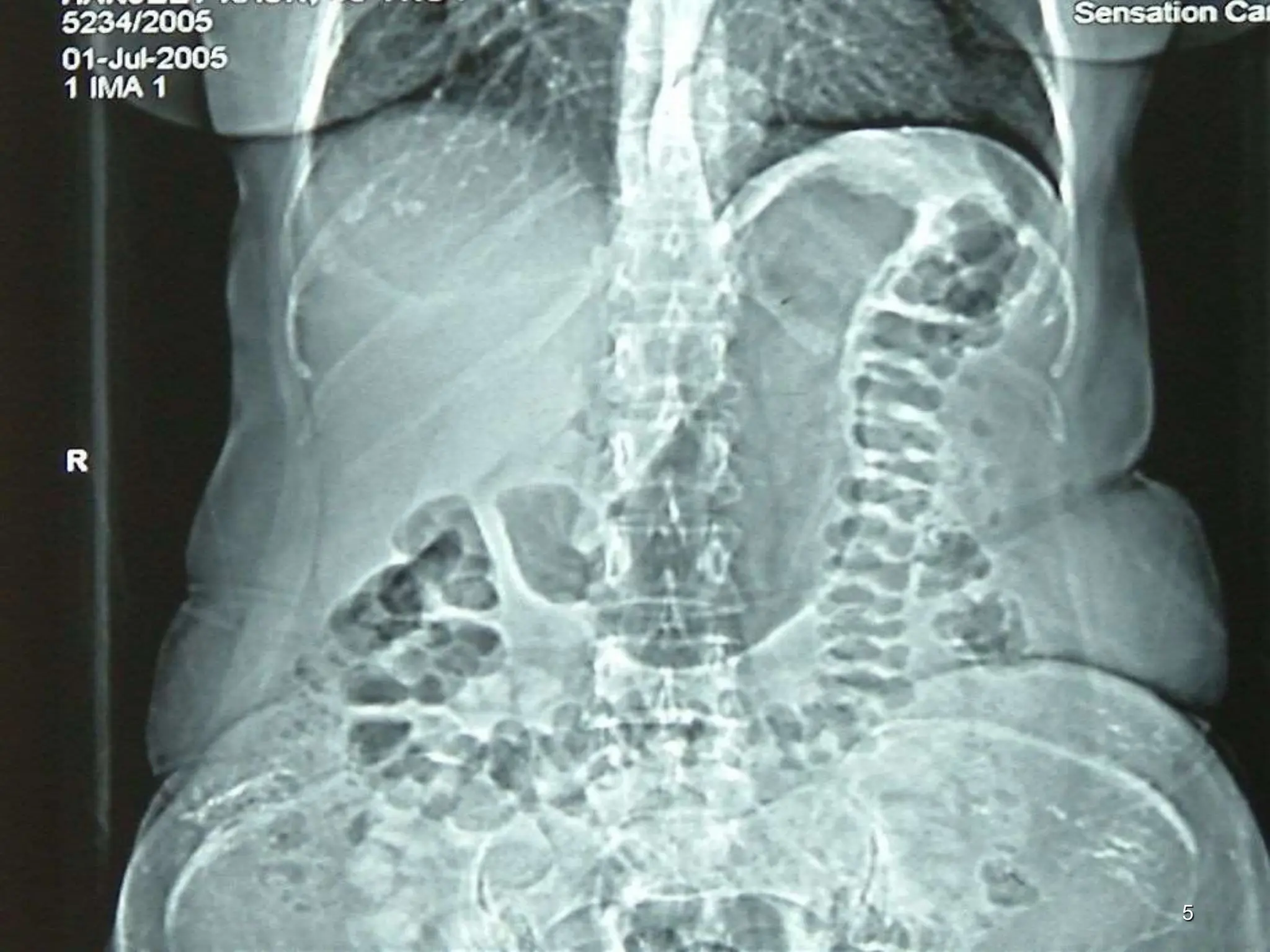 GIST (Gastrointestinal Stromal Tumor).ppt | Digestive Disorders ...