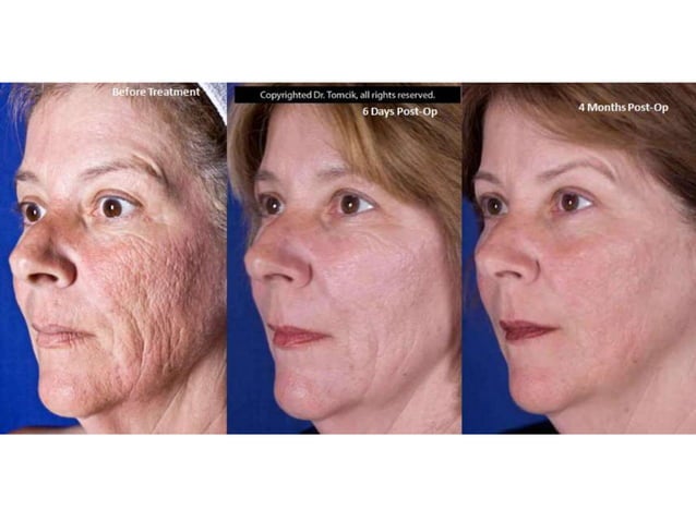 Before & After Slide Presentation | PPT