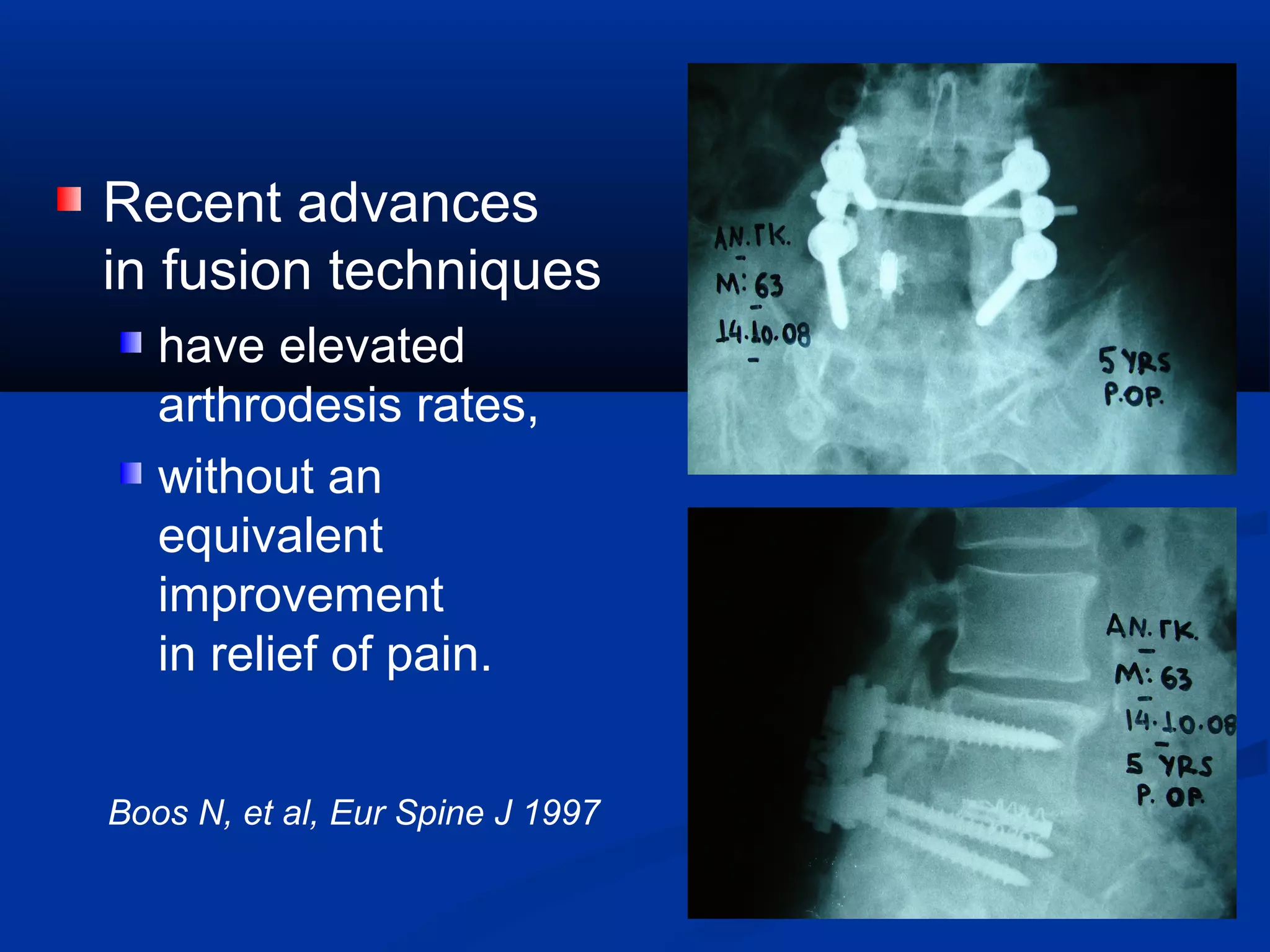 Dynamic Stabilization in the Surgical Management of Painful Lumbar ...