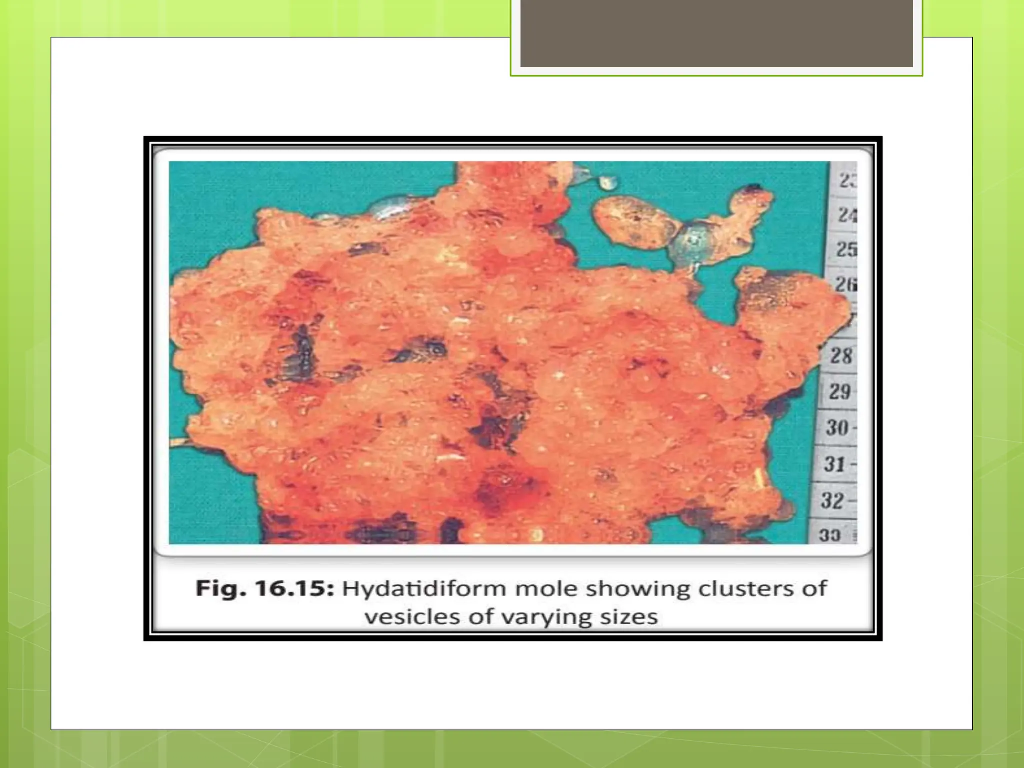 3) HYDATIDIFORM MOLE.pptx