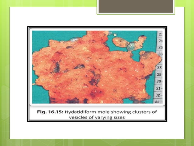 3) HYDATIDIFORM MOLE.pptx