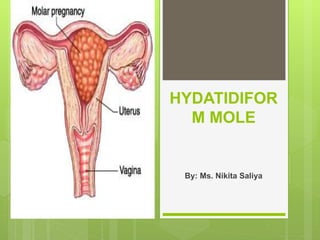 3) HYDATIDIFORM MOLE.pptx