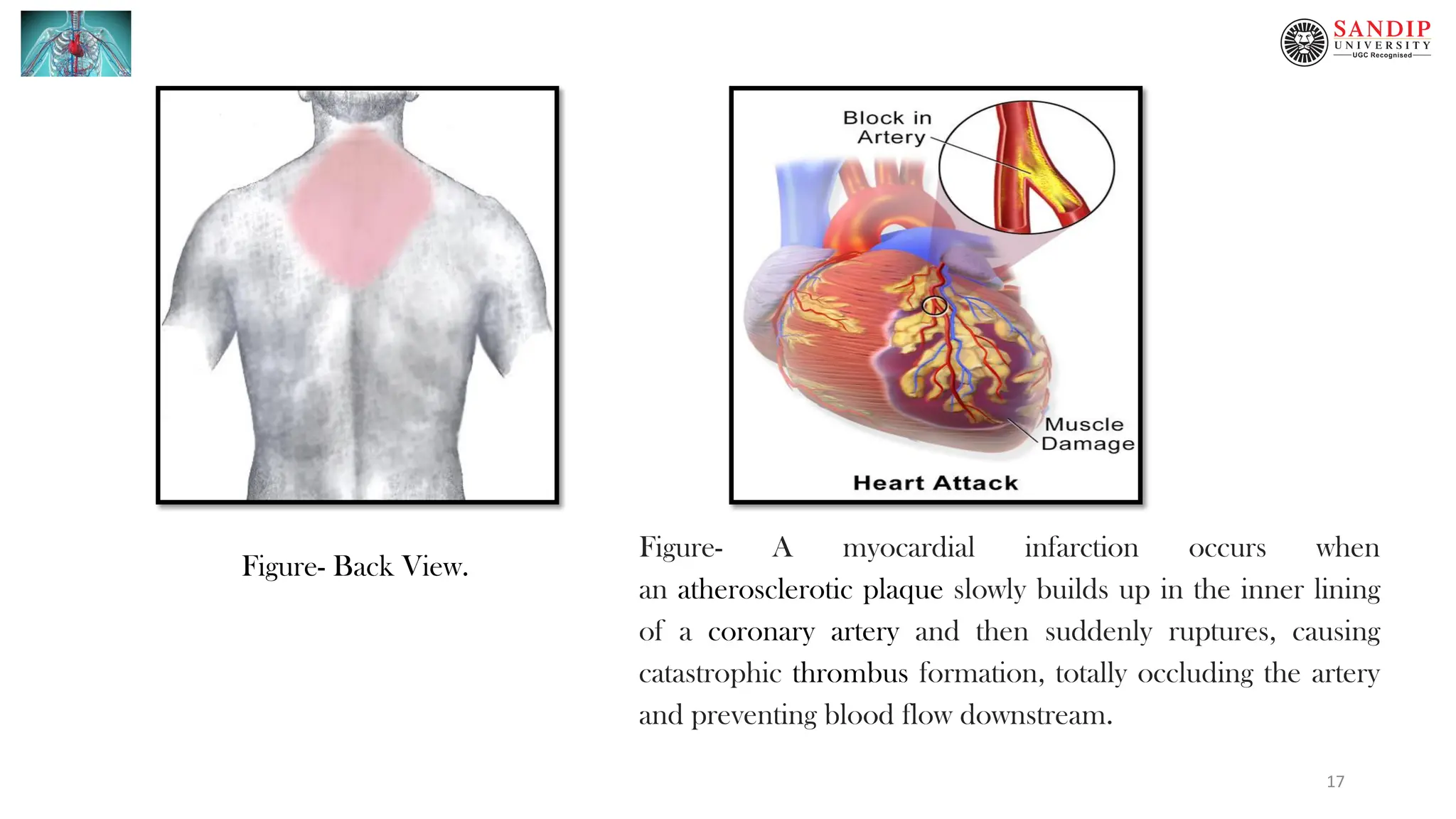 Cardiovascular Pathophysiology- Coronary Artery Disease (CAD)/Ischaemic ...